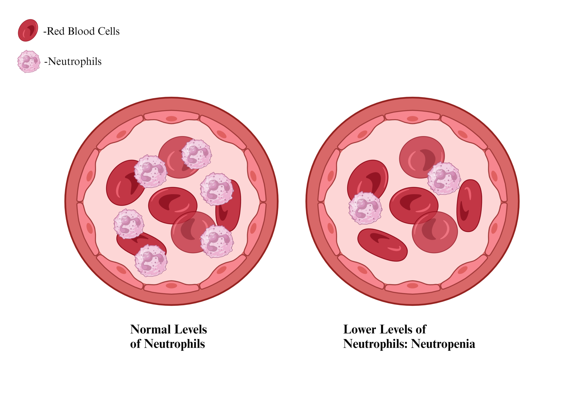 Understanding Neutropenia – sayretherapeutics